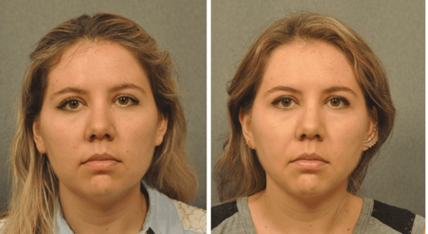 Cheeks Liposuction in San Jose: Make Cheekbones High & Prominent